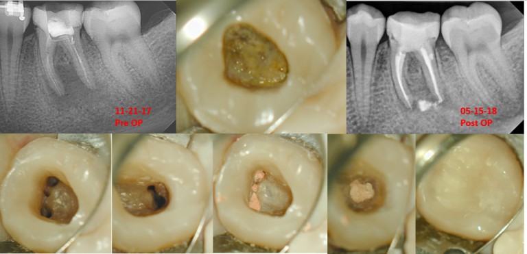 Retreatment on a Mandibular 1st Molar on Teenager – TDO University