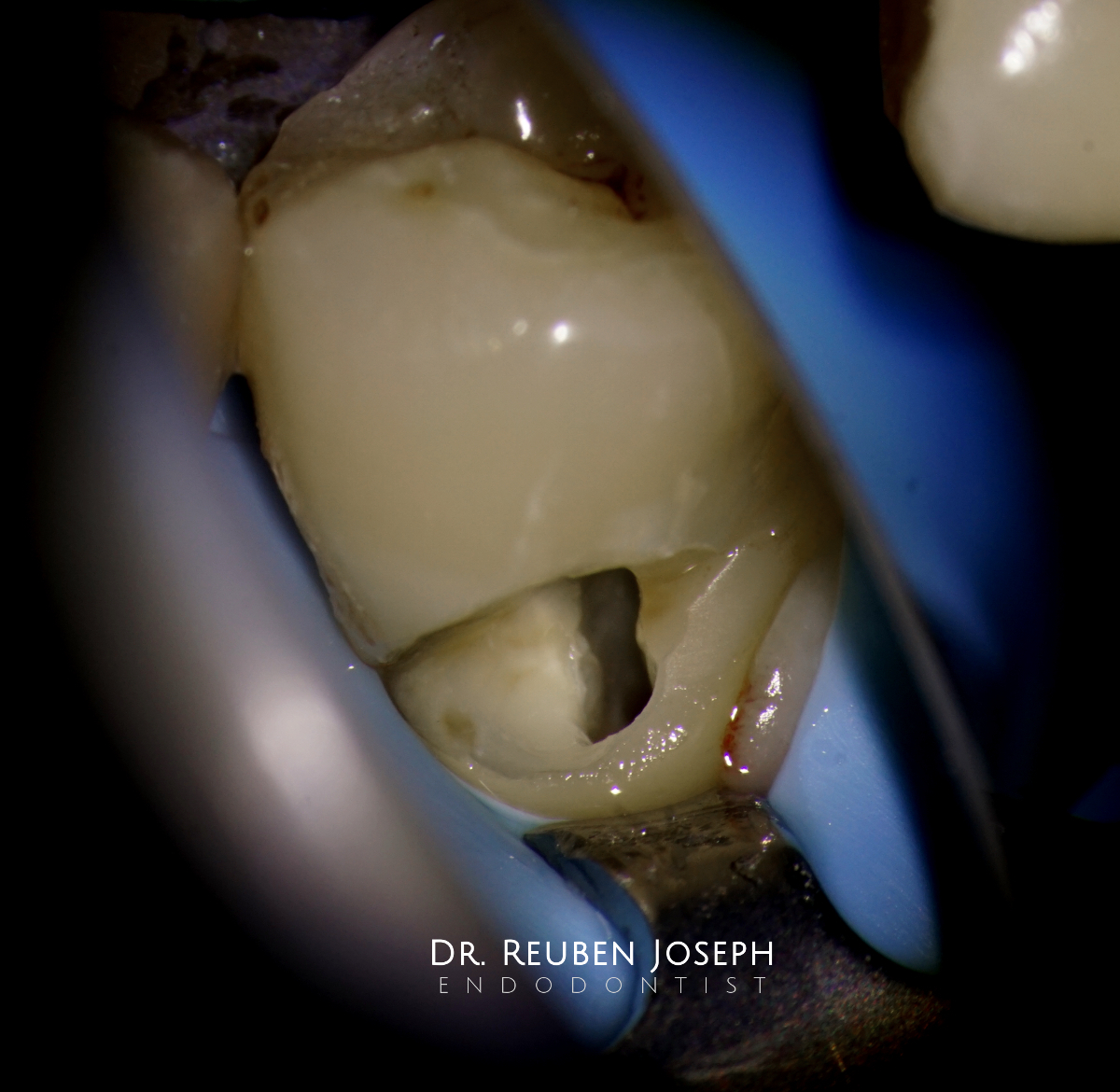 Caries Driven Access – #29 – TDO University