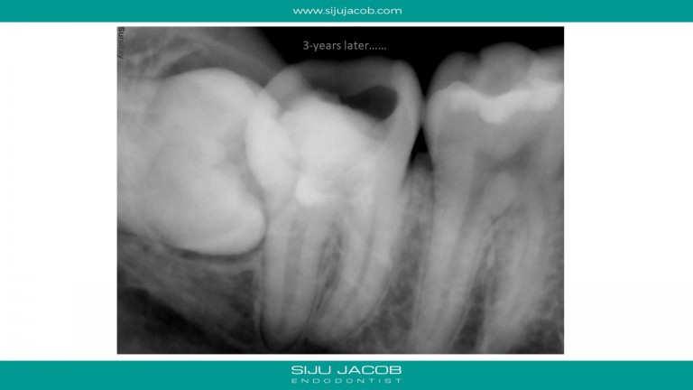 Apexogenesis + Selective Endo – TDO University