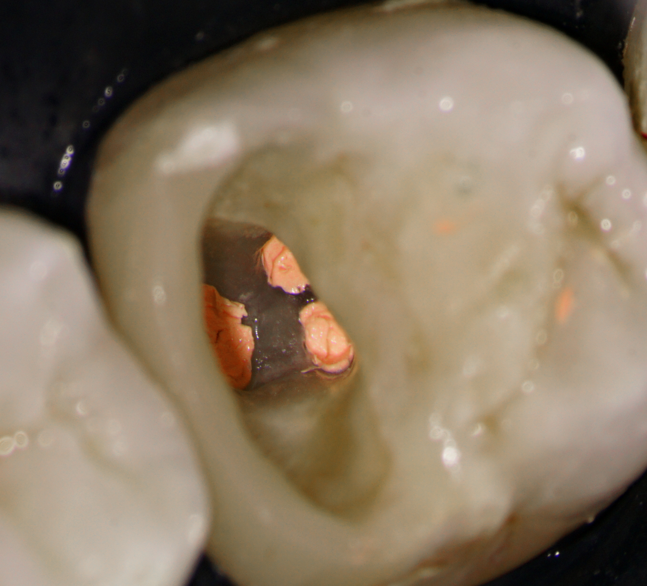 #19 Caries Driven access – TDO University