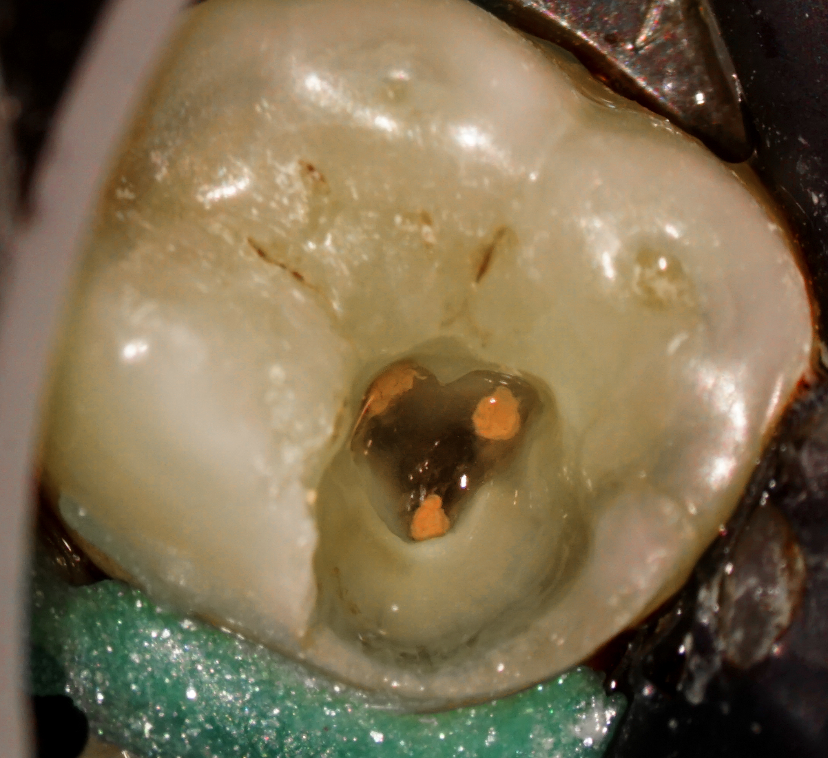 #30 – Caries Driven Access – TDO University