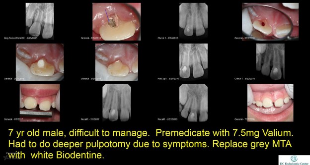 Apexogenesis – TDO University