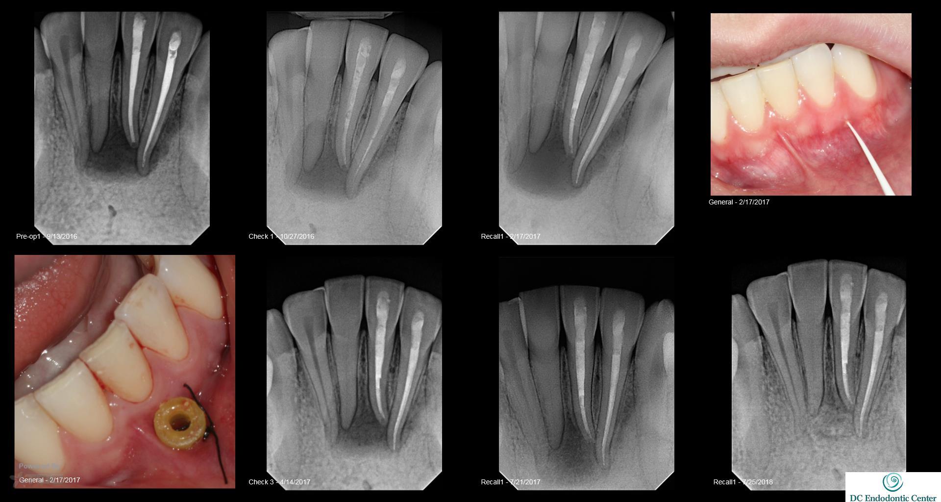 Pt presented with persistent sinus tract on B – TDO University
