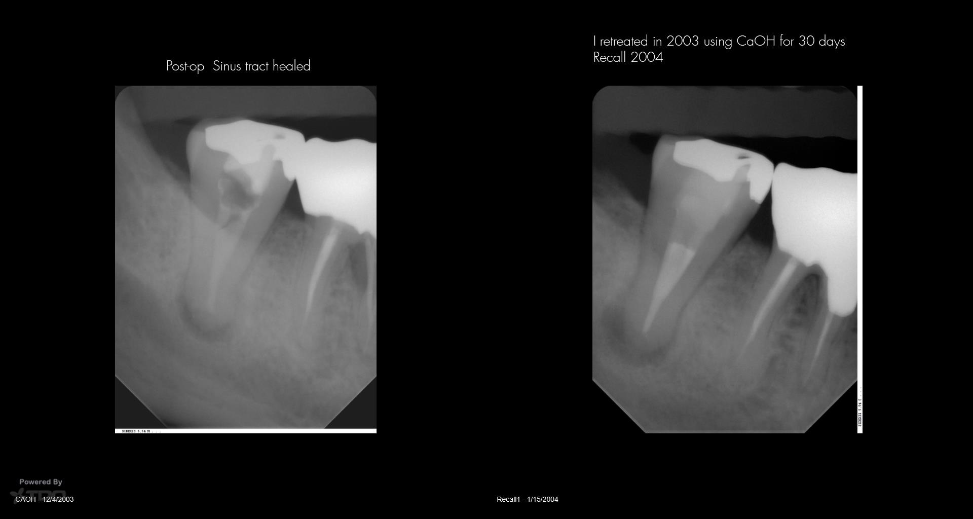 Tooth #31 – TDO University