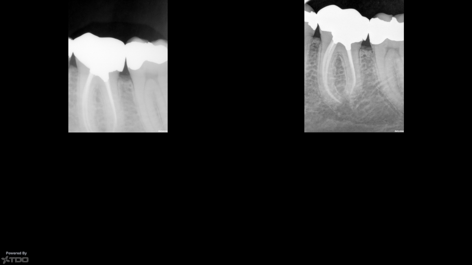 Pulp horns, deep finish lines – TDO University