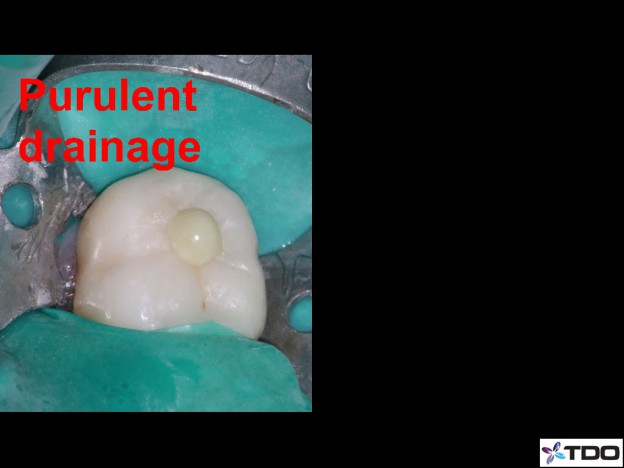 #31 Purulent drainage 3v 2 – TDO University