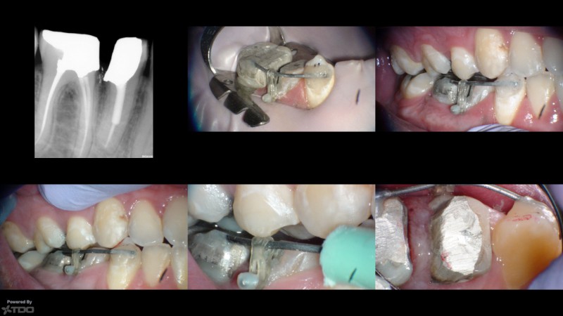 First ortho extrusion courtesy of Scott Weed. – TDO University