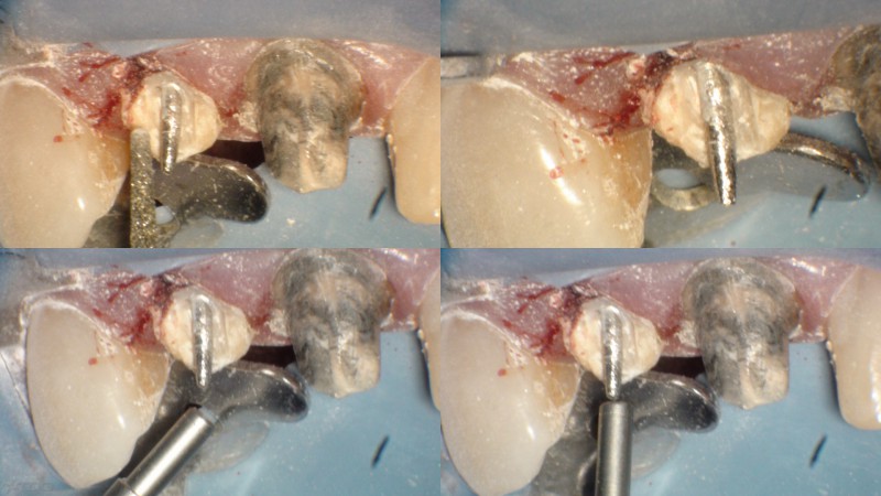 How to actually use the Gonon/Ruddle post removal system – TDO University