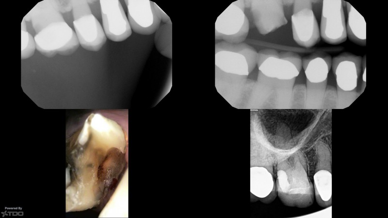 Injection-molded ferrule resurrection w/o endo – TDO University