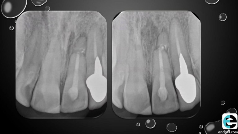 Dental Trauma : Horizontal fracture – A short term follow up – TDO ...