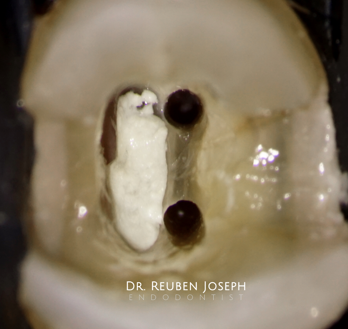 #24 with a Iatrogenic perfortion/ Calcified canals/ fracture in the ...