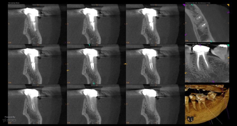 fracture case” CBCT of “good root” – TDO University